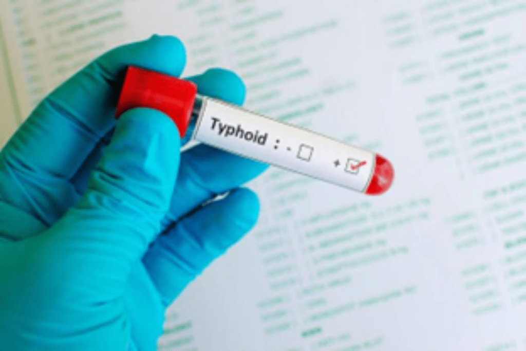 Effective Home Remedies for Typhoid: Natural Ways to Speed Recovery ...